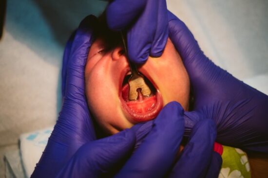 5 Signs Your Child Needs a Frenectomy - Pediatric Dentistry ...